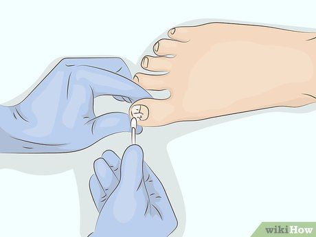 Treating Onycholysis (Nail Separation) – Mytour