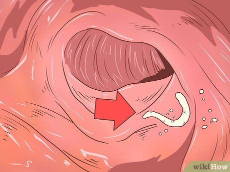 How to Identify and Prevent Pinworm Infection: 13 Steps – Mytour