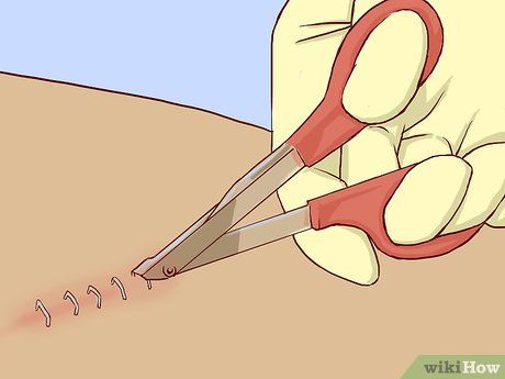 How to Remove Surgical Pins: 8 Steps (with Pictures) – Mytour
