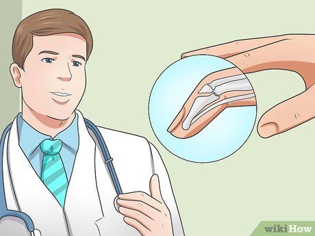 How to Splint a Finger with a Torn Extensor Tendon: 9 Steps (with Images)