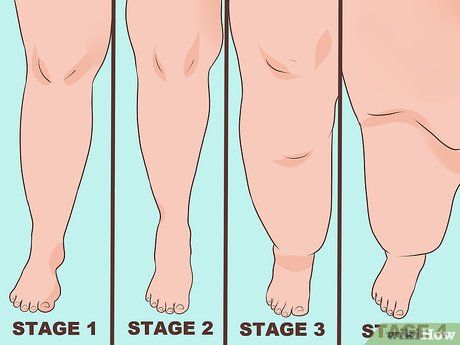 How to Diagnose Lipedema