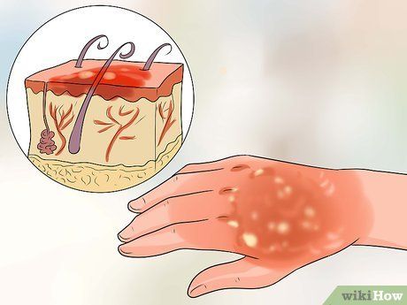 How to Treat Scalds from Boiling Water