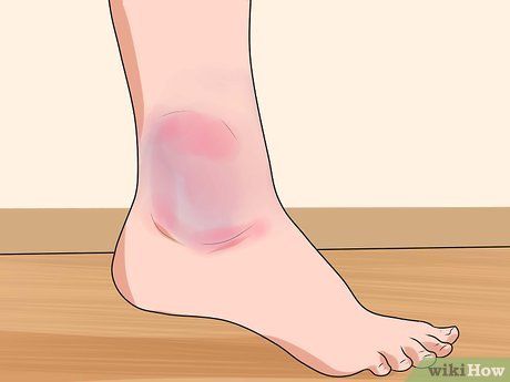 How to Identify the Symptoms of an Ankle Sprain (with Photos)