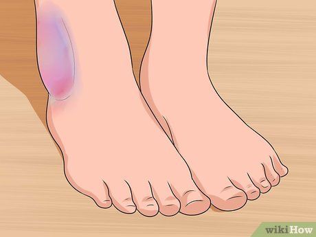 How to Identify the Symptoms of an Ankle Sprain (with Photos)