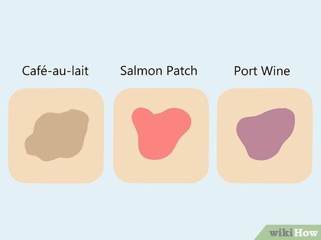 How to Fade Birthmarks: Are Natural Remedies Effective?