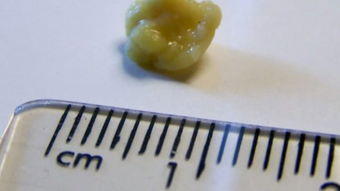 What are Tonsil Stones?