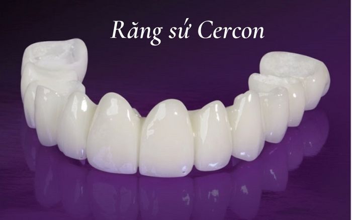 Răng sứ Cercon - Giá cả và chất lượng ra sao?