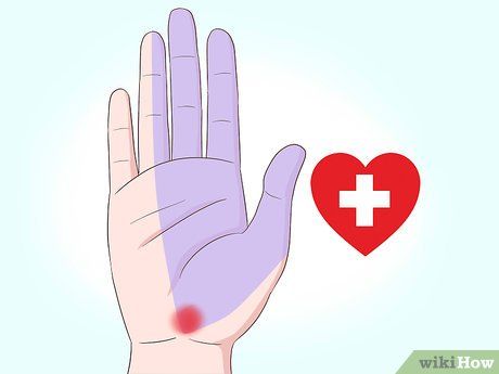 How to Reduce Swollen Fingers: 12 Steps (with Pictures) – Mytour